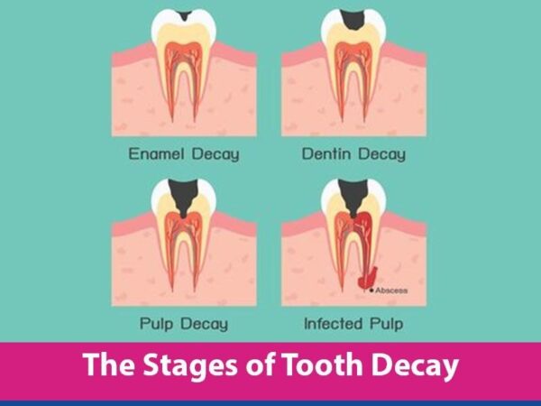 Root Canal | The Dentist Coimbatore